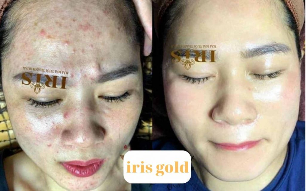 Liệu Trình Điều Trị Chàm Xanh Đen, Mụn, Sẹo Rổ Với Iris Gold